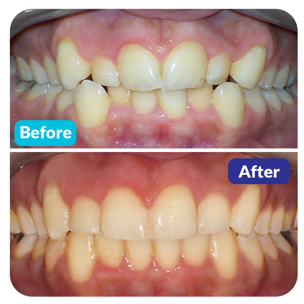 Case Library - My Line Aligner