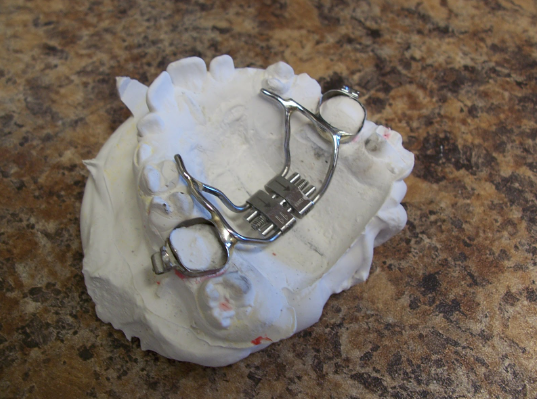 What is a crossbite teeth? - My Line Aligner
